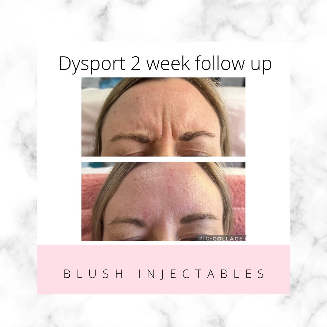 Before & After | Blush Injectables