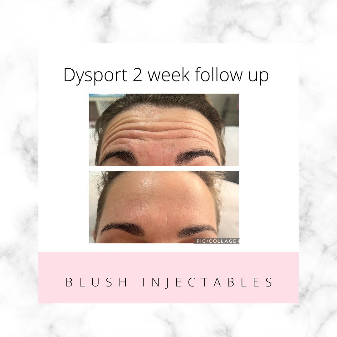 Before & After | Blush Injectables