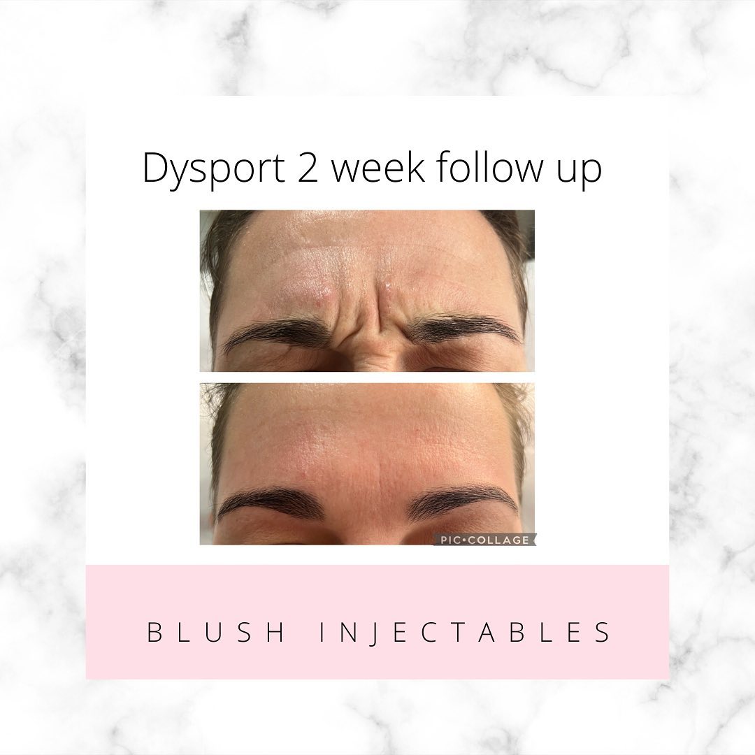 Before & After | Blush Injectables