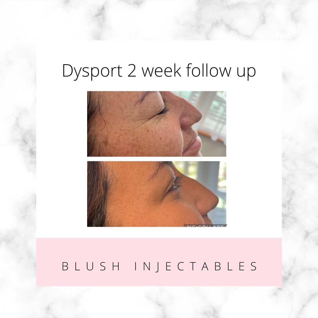 Before & After | Blush Injectables