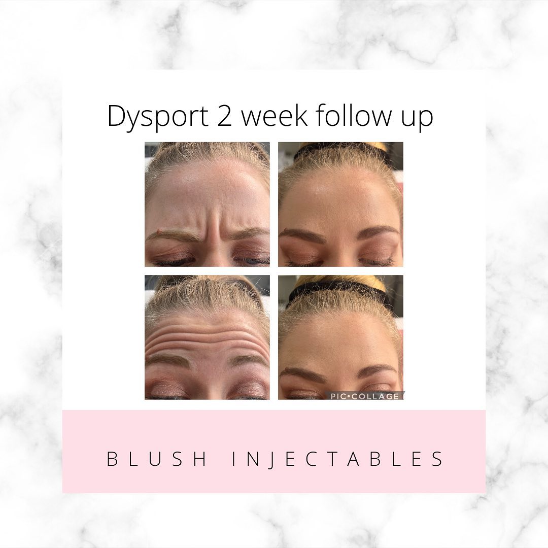 Before & After | Blush Injectables