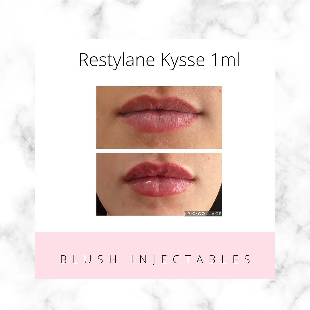 Before & After | Blush Injectables