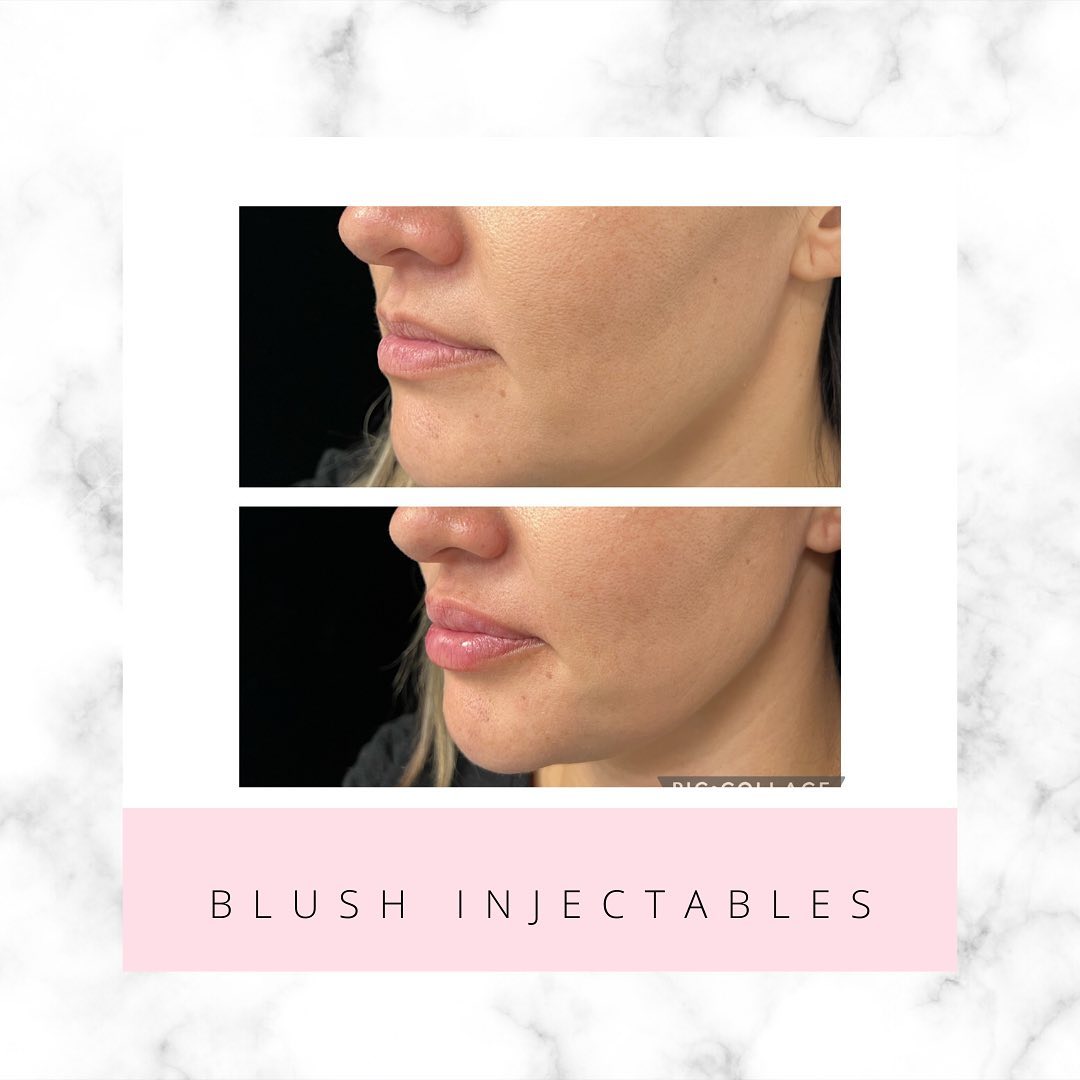 Before & After | Blush Injectables