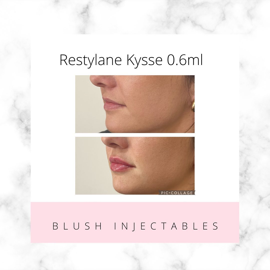 Before & After | Blush Injectables
