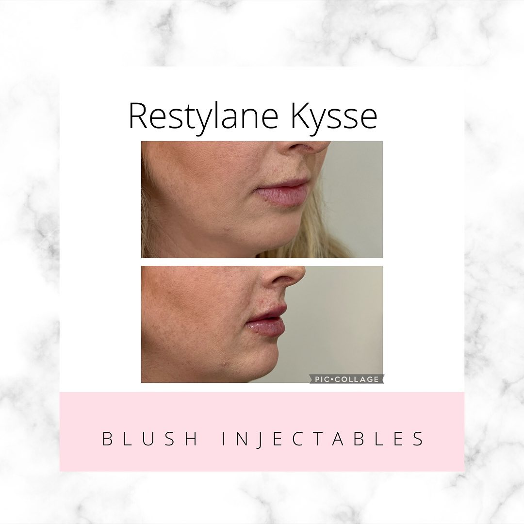 Before & After | Blush Injectables