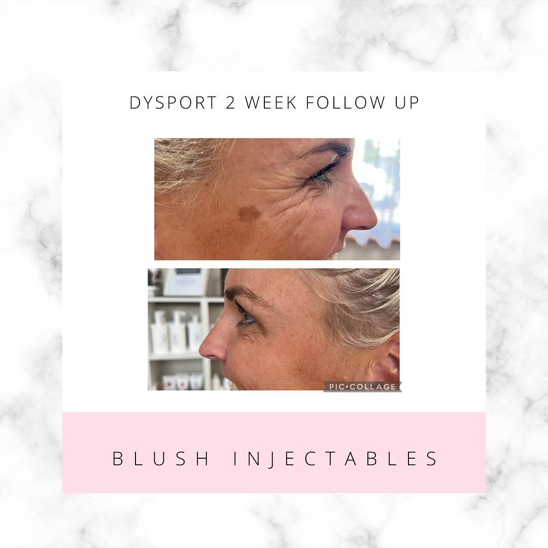 Before & After | Blush Injectables