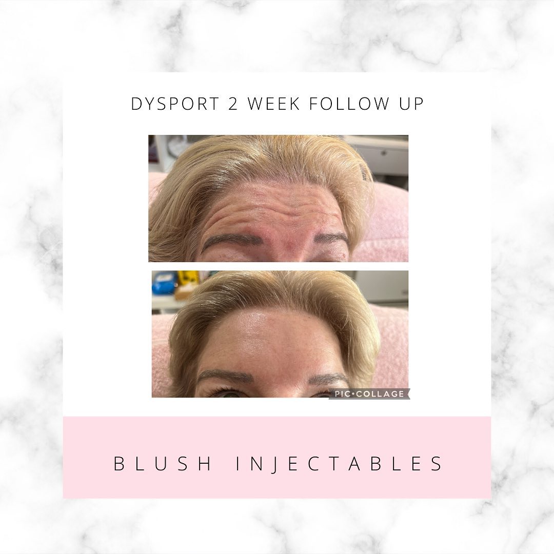 Before & After | Blush Injectables
