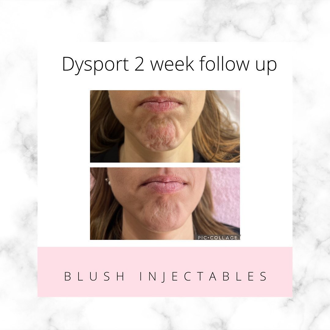 Before & After | Blush Injectables