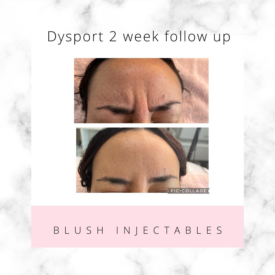 Before & After | Blush Injectables