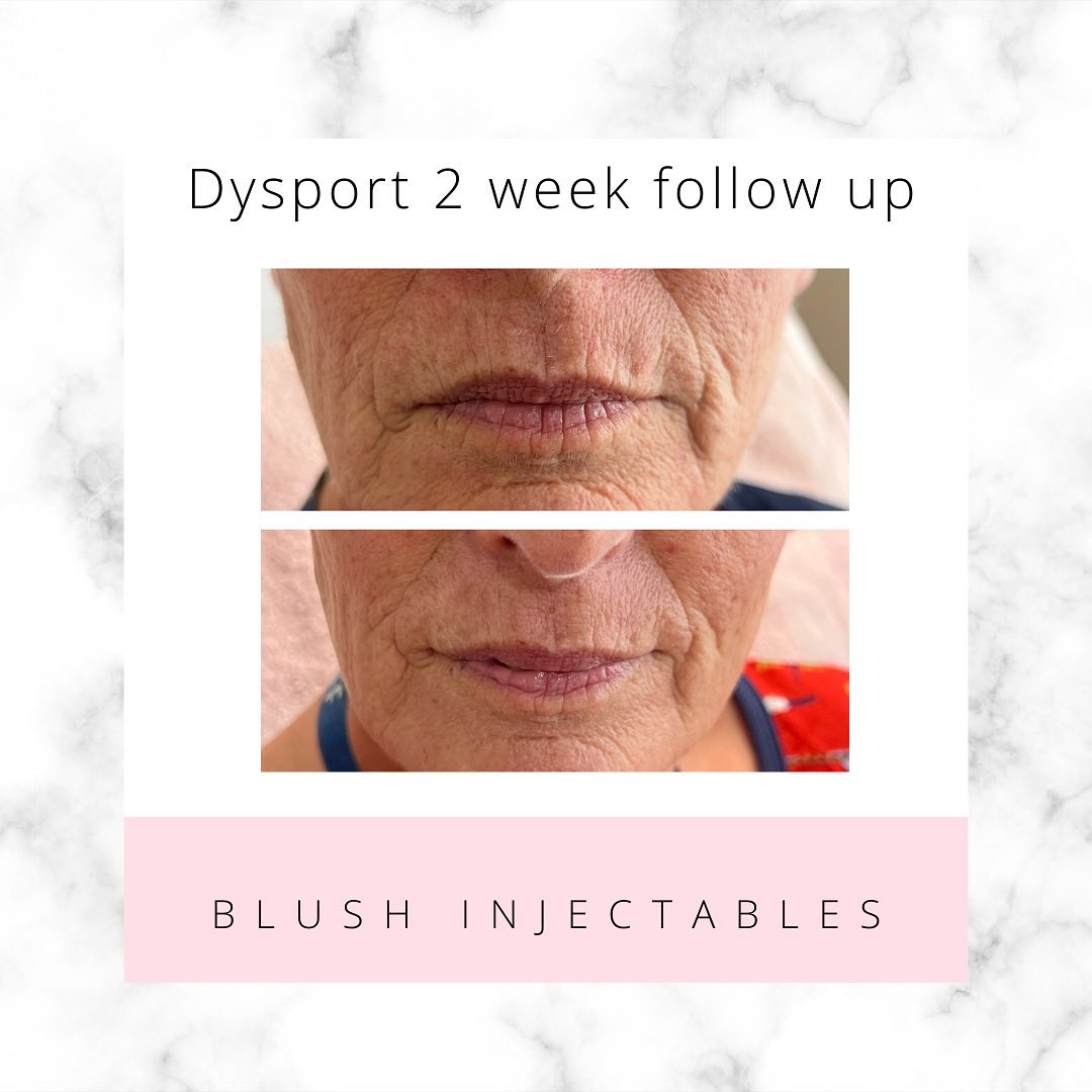 Before & After | Blush Injectables