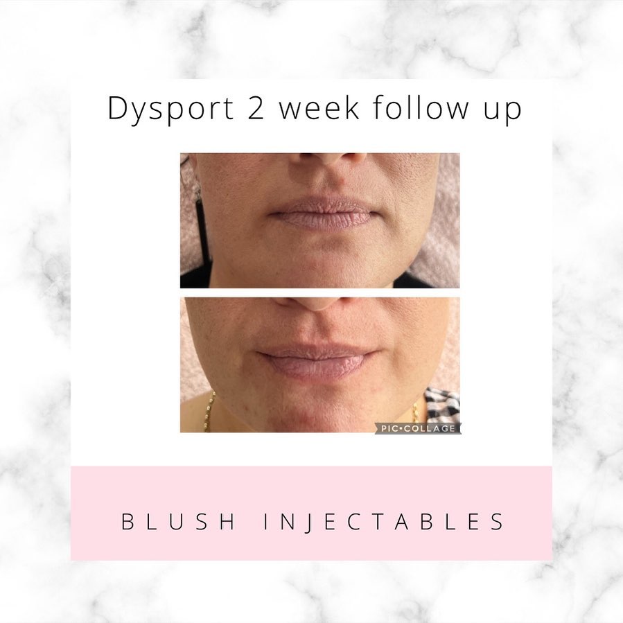 Before & After | Blush Injectables