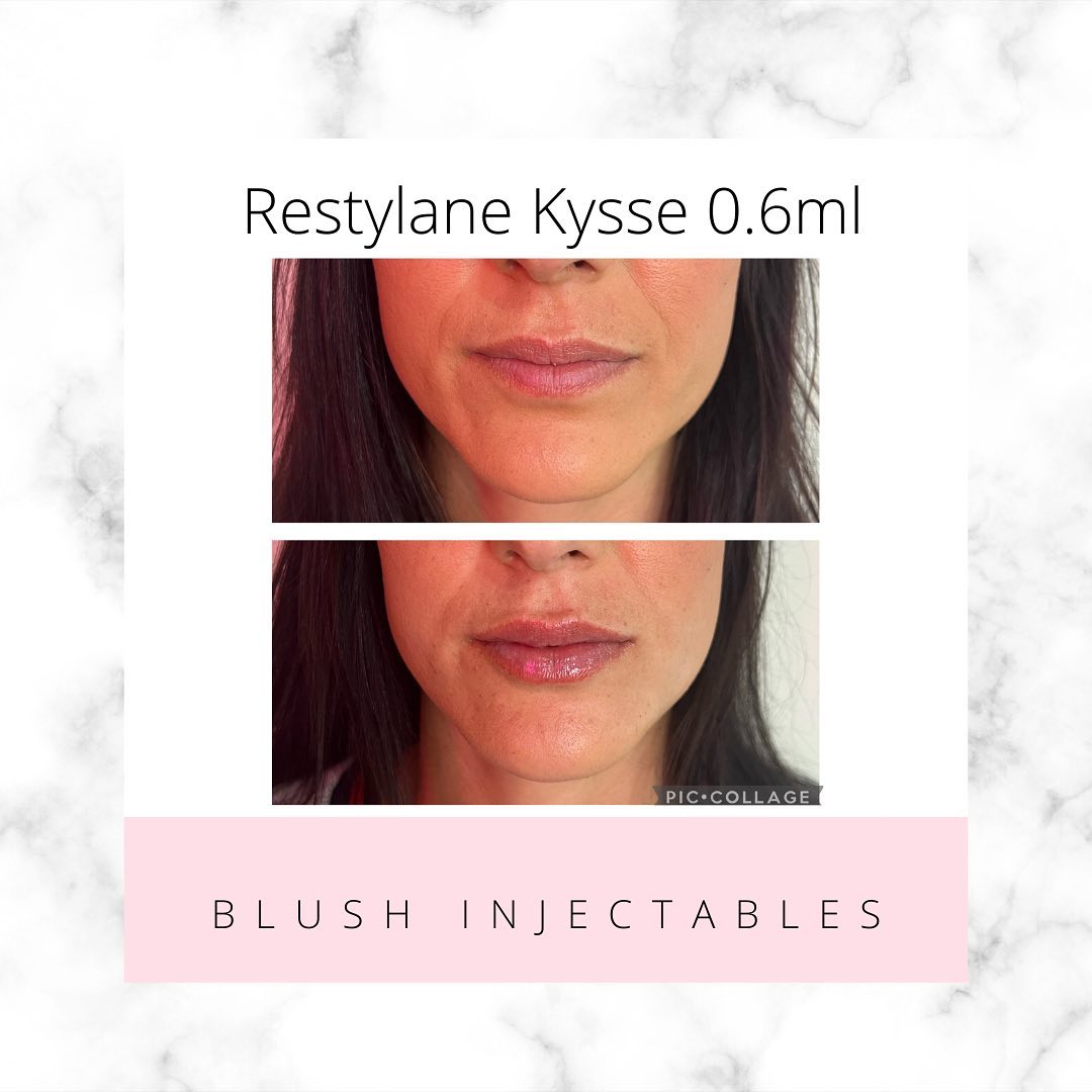 Before & After | Blush Injectables